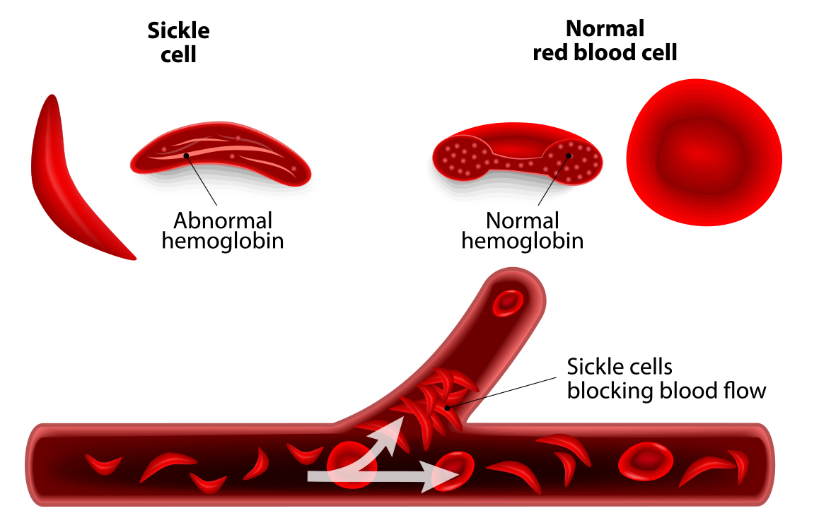 Support for their sickle cell disease journeys | Marquette Today