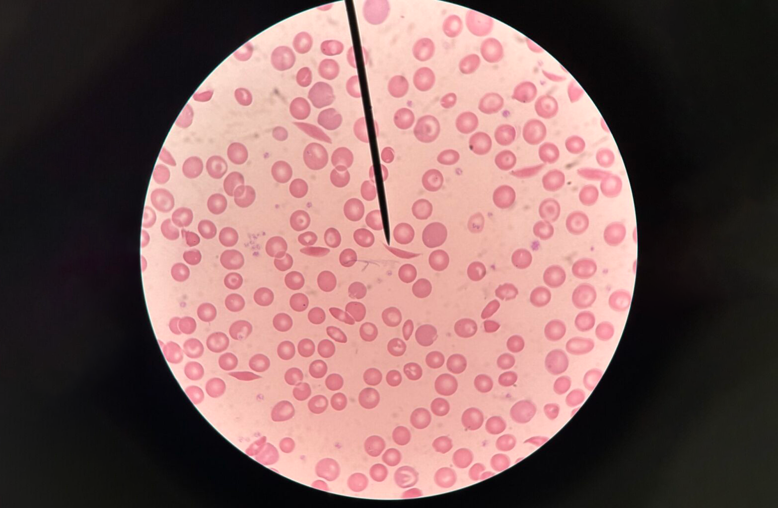 Sickle Cells Sickle Cells